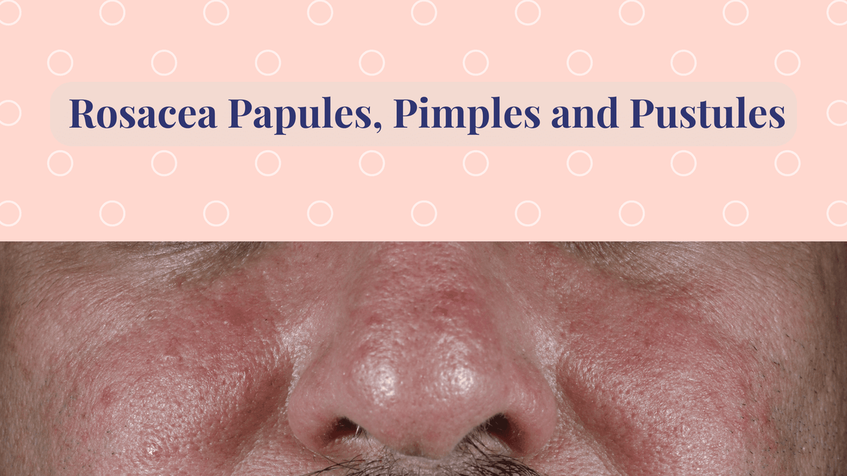 Rosacea Acne: Papulopustular Rosacea